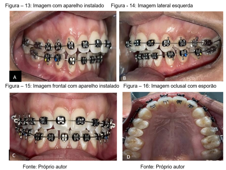 UTILIZAÇÃO DO PROPULSOR MANDIBULAR PMW COMO ALTERNATIVA DE TRATAMENTO ...
