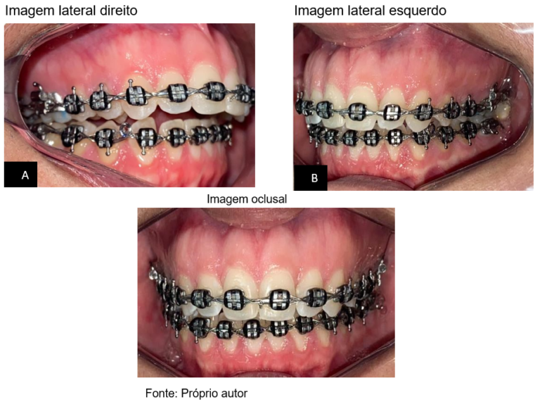 UTILIZAÇÃO DO PROPULSOR MANDIBULAR PMW COMO ALTERNATIVA DE TRATAMENTO ...