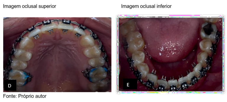 UTILIZAÇÃO DO PROPULSOR MANDIBULAR PMW COMO ALTERNATIVA DE TRATAMENTO ...