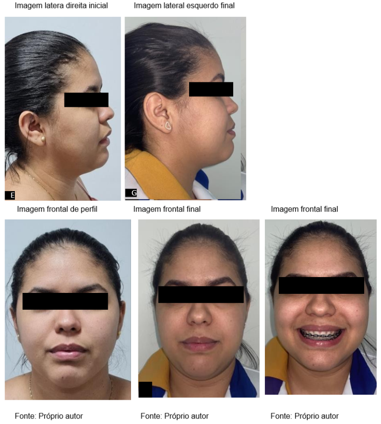 UTILIZAÇÃO DO PROPULSOR MANDIBULAR PMW COMO ALTERNATIVA DE TRATAMENTO ...