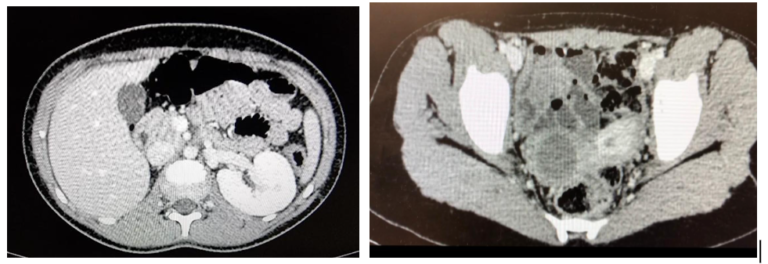 SÍNDROME OHVIRA (HEMIVAGINA OBSTRUÍDA E ANOMALIA RENAL IPSILATERAL ...