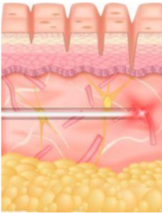 O TRATAMENTO DO ENDOLASER EM GORDURA LOCALIZADA – ISSN 1678-0817 Qualis B2