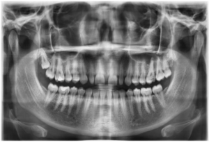 TERCEIRO MOLAR INCLUSO/IMPACTADO-RELATO DE CASO – ISSN 1678-0817 Qualis B2