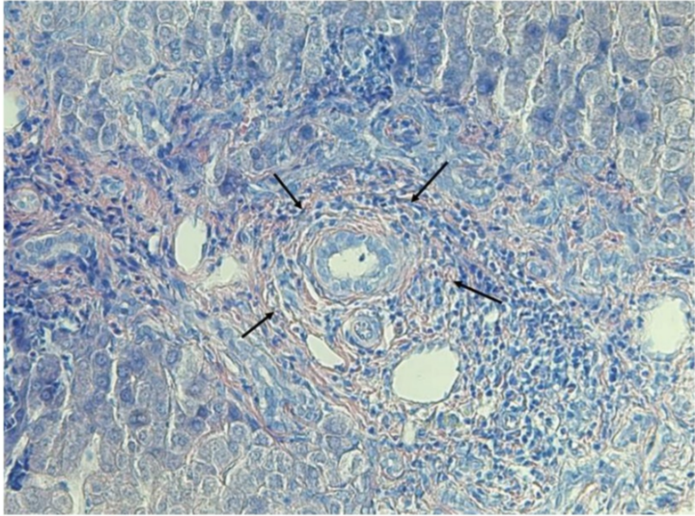 REVISÃO DE LITERATURA: MANEJO DO PACIENTE COM COLANGITE ESCLEROSANTE ...