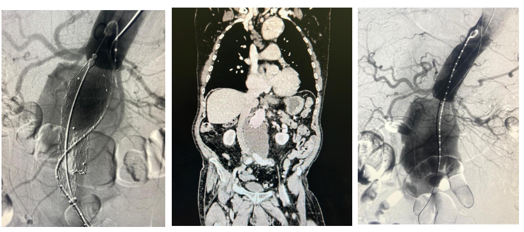 ANEURISMA DE AORTA ABDOMINAL JUSTARRENAL COM FISTULIZAÇÃO CAVAL EM ...