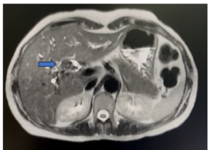 ANASTOMOSE BILEODIGESTIVA EM PACIENTE COM COLEDOCOLITÍASE E CÁLCULO ...